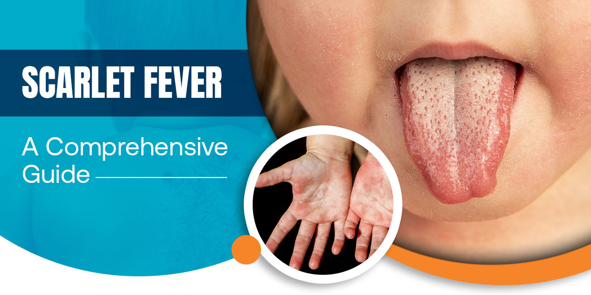 Scarlet fever: Symptoms, Causes, Diagnosis and Treatment